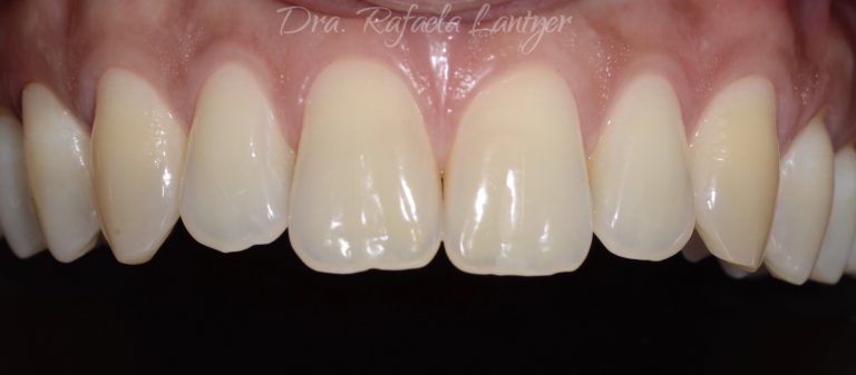 Retração da gengiva: como solucionar? - Dra. Lia Alves Schinetski